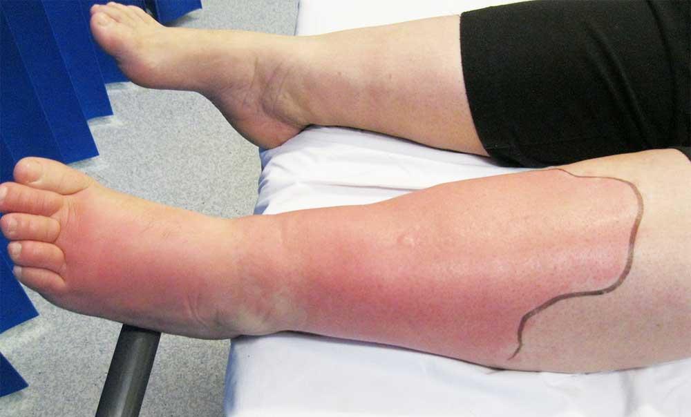 Cellulitis Emergency: What you Need to know, When to go to the ER